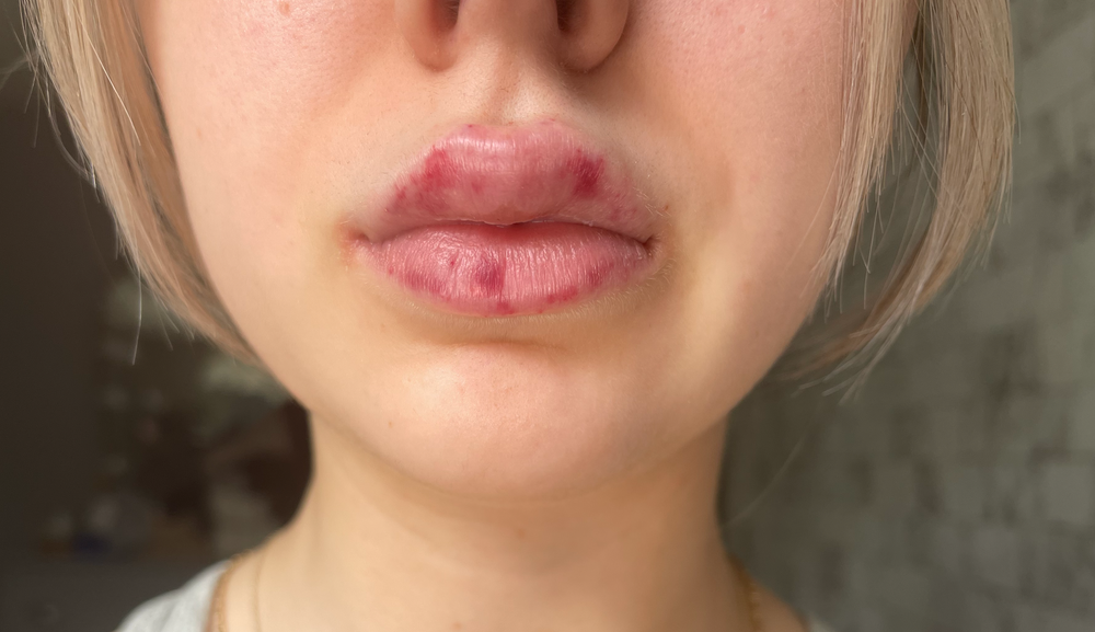 Exploring the Reasons Behind Lip Filler Swelling