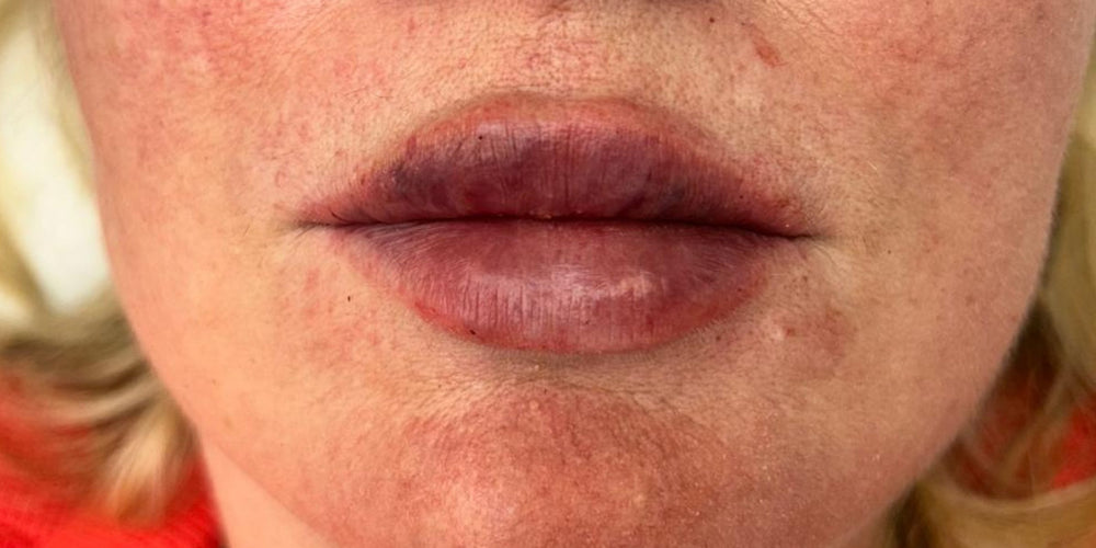 AfterMED Lips - Aftercare For Lip Filler