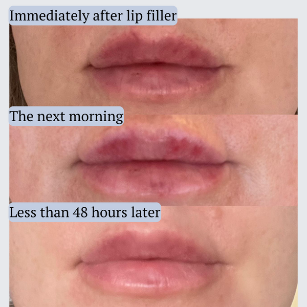 What Is Lip Blushing? The Treatment Process & Healing Stages Explained
